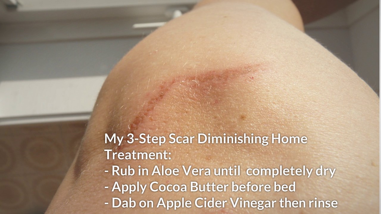 HOME SCAR TREATMENTS REVEALED - Reduce scars caused by acne, bites ...