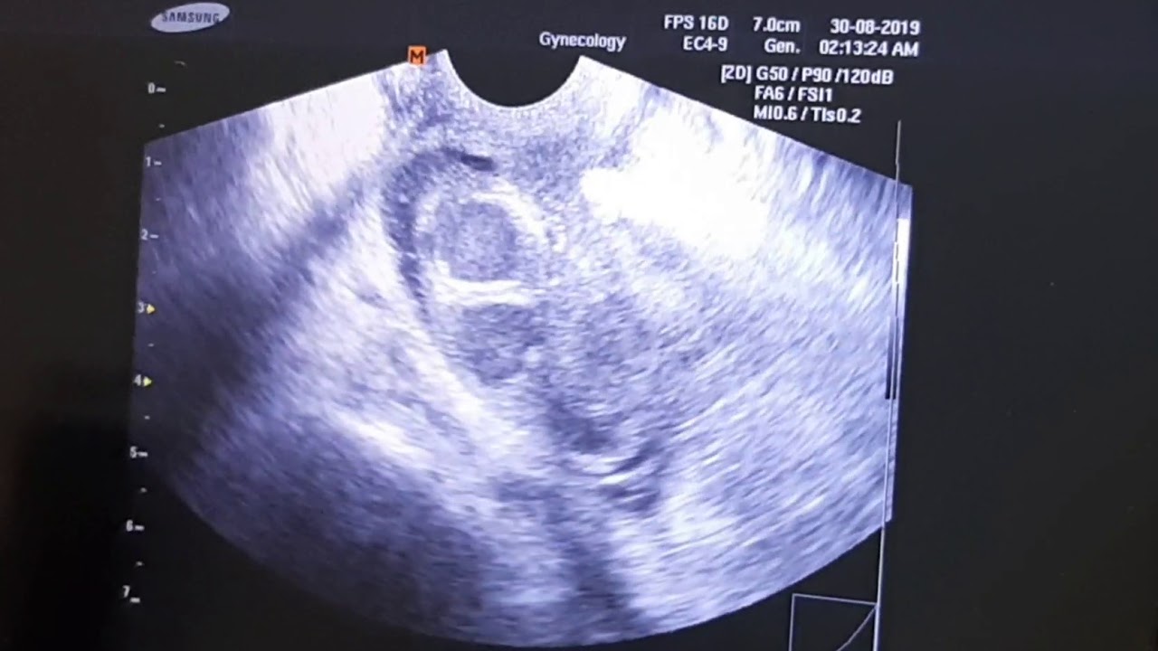 Acute PID , pyosalpinx التهاب الأنابيب الرحميه والمبايض - YouTube