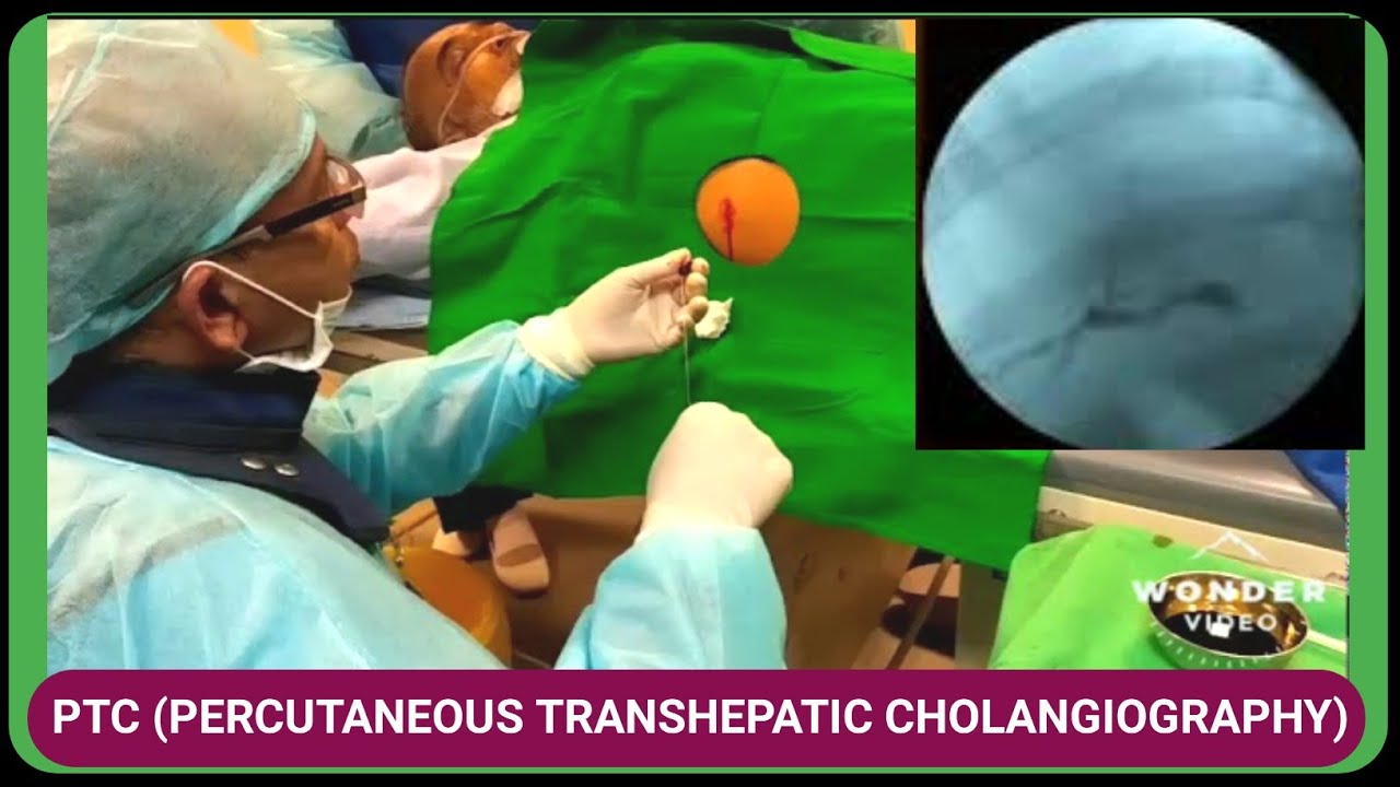 PTC Rare Case in Bangladesh - Prof M S Arfin Percutaneous Transhepatic ...