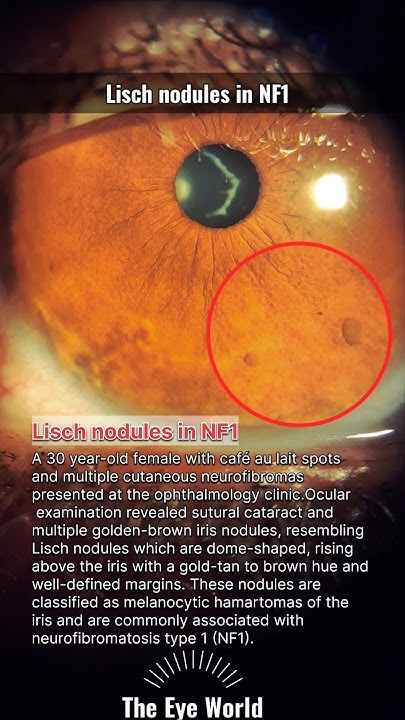 Lisch nodules in neurofibromatosis type 1 #eyes #ophthalmology #iris #the_eye_world - YouTube