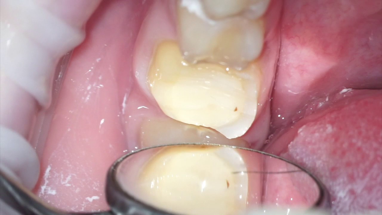 Molar prep emax - YouTube