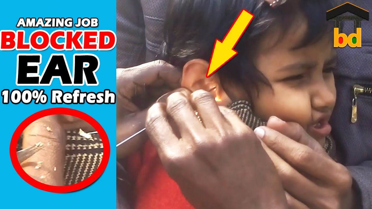 (1st Time) Blocked Ear Cleaning Marathon II Most Satisfying Ear Waxing ...