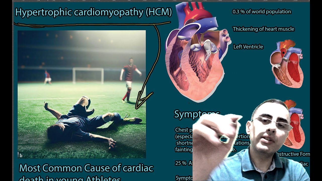 Hypertrophic cardiomyopathy (HCM) Symptoms, causes, Treatment - YouTube