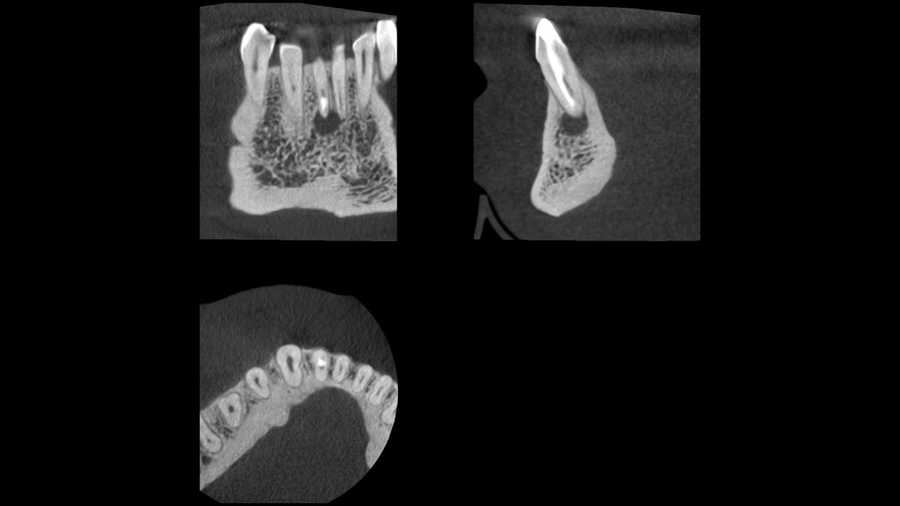 Non-surgical or surgical reRCT LR2? - YouTube