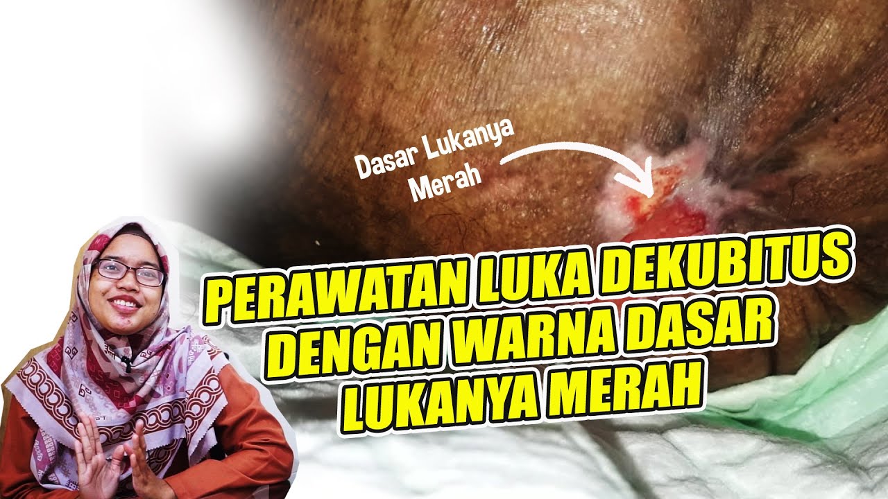 Perawatan luka tekan dengan dasar luka merah - YouTube