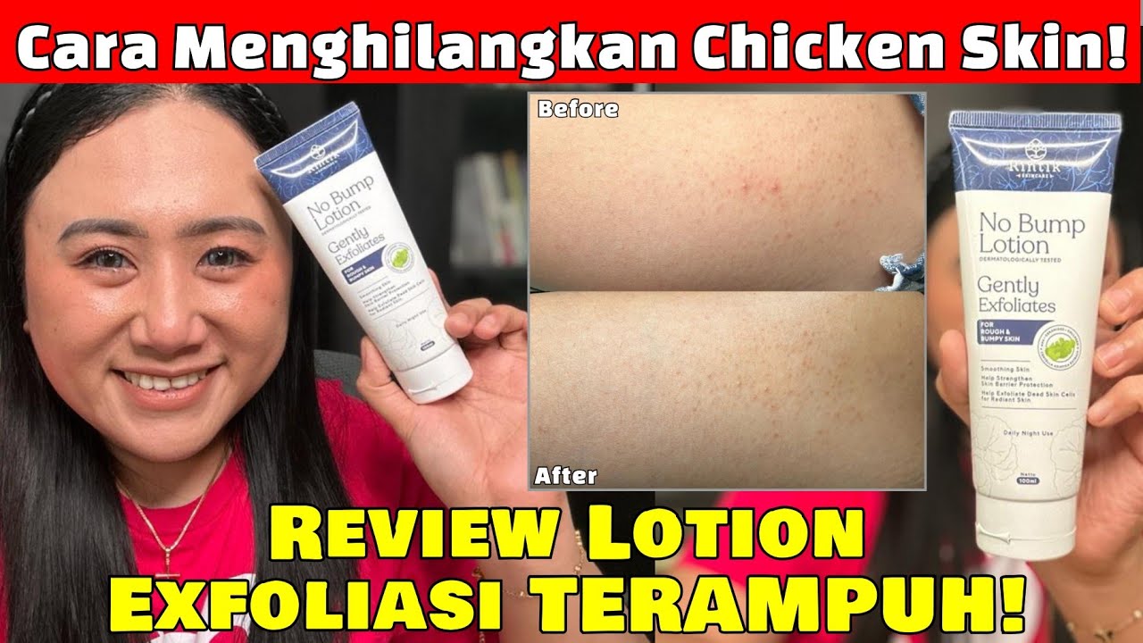 CARA MENGHILANGKAN CHICKEN SKIN FULL REVIEW NO BUMP LOTION RINTIK ...