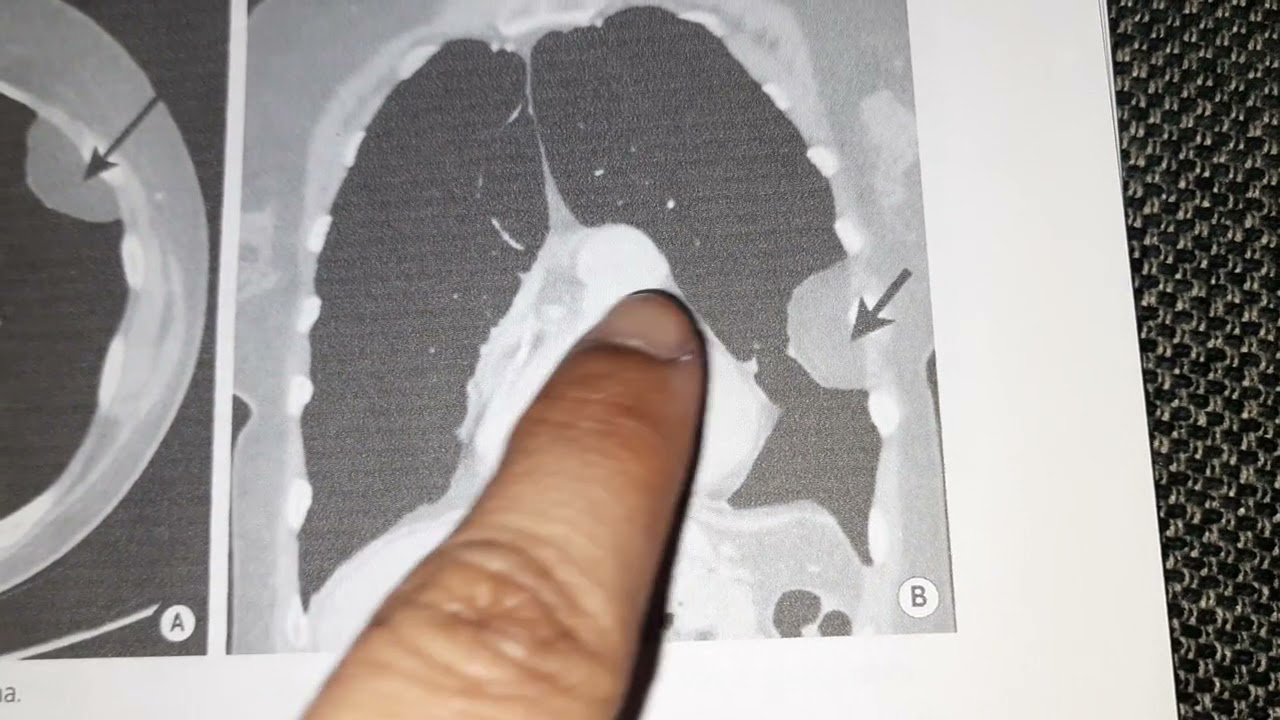 image chest wall lipoma mp4 || Radiology - YouTube