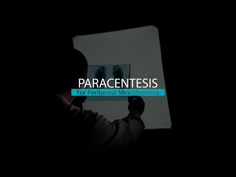 Paracentesis for Peritoneal Mesothelioma | Mesothelioma Hope