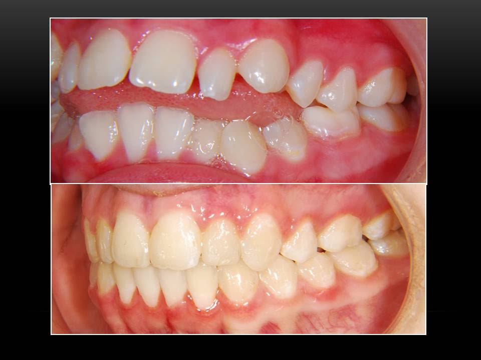 Amazing Open Bite Correction ! 2: Orthodontist - YouTube