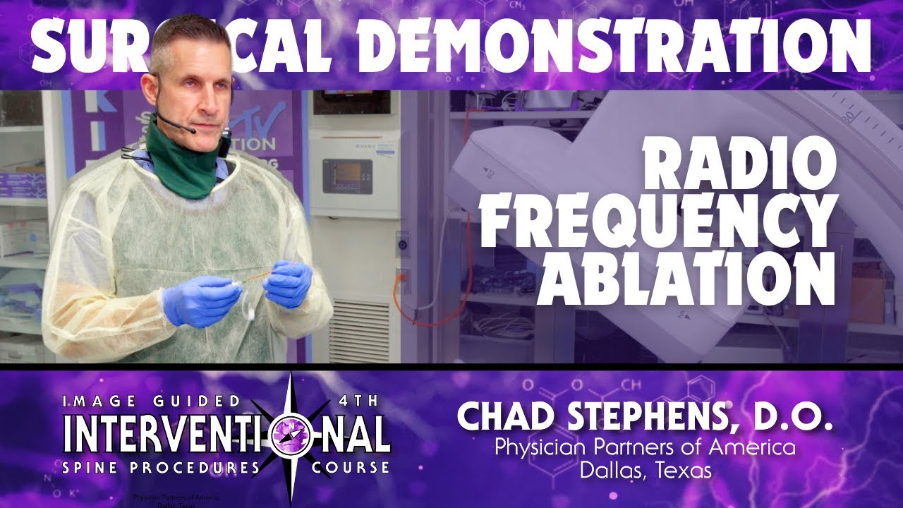 Radiofrequency Ablation - Chad Stephens, D.O. - YouTube