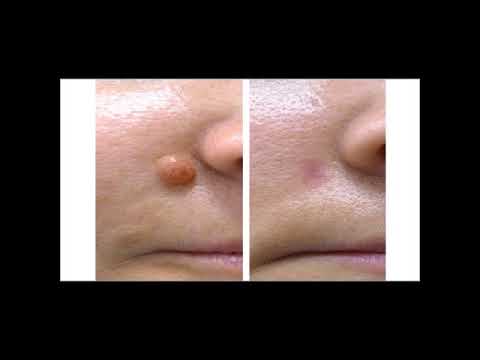 Gutartige Hauttumoren – Atherom - YouTube