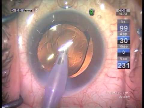 Hands On Phaco Surgery Training & Fellowship in India - YouTube