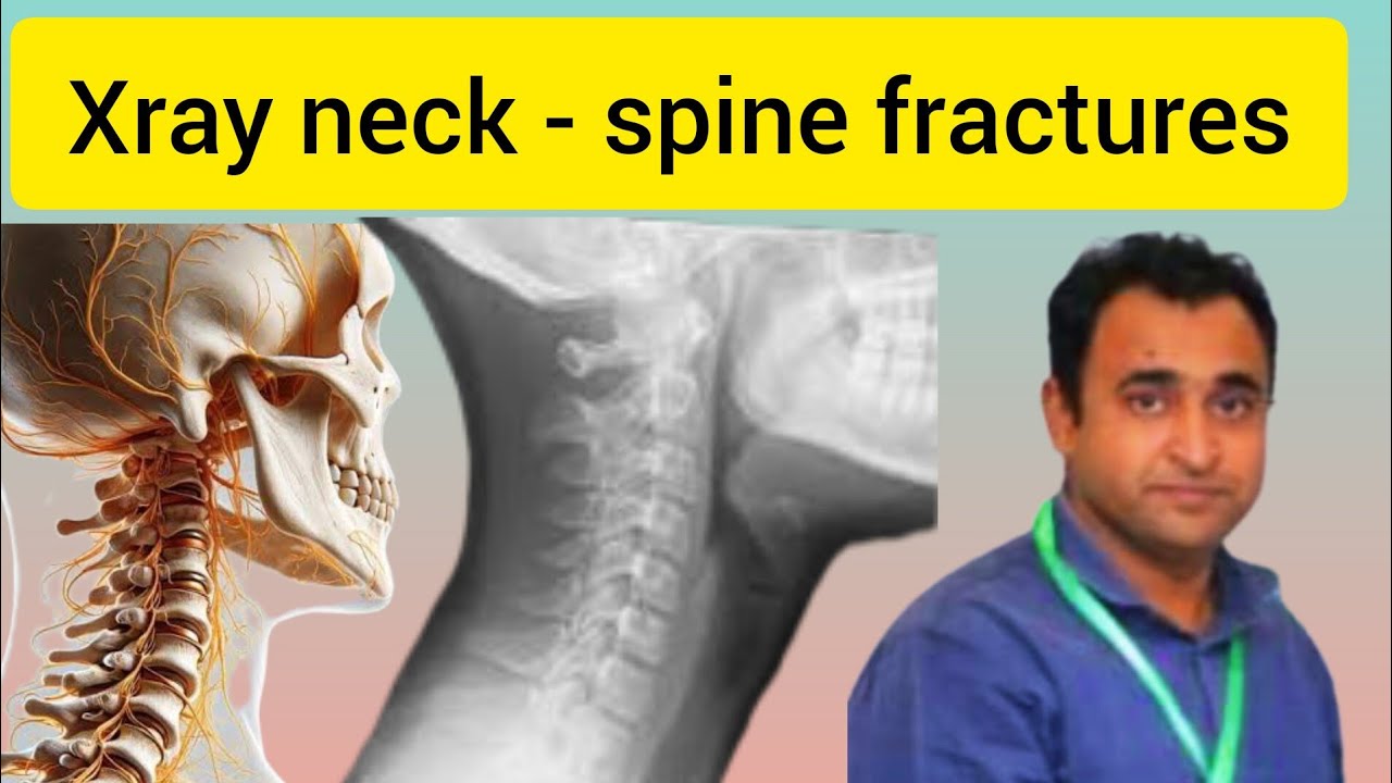 cervical spine fractures radiology - part 2 - YouTube