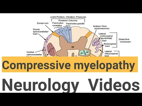 Compressive myelopathy - Neurology videos learn by seeing - YouTube