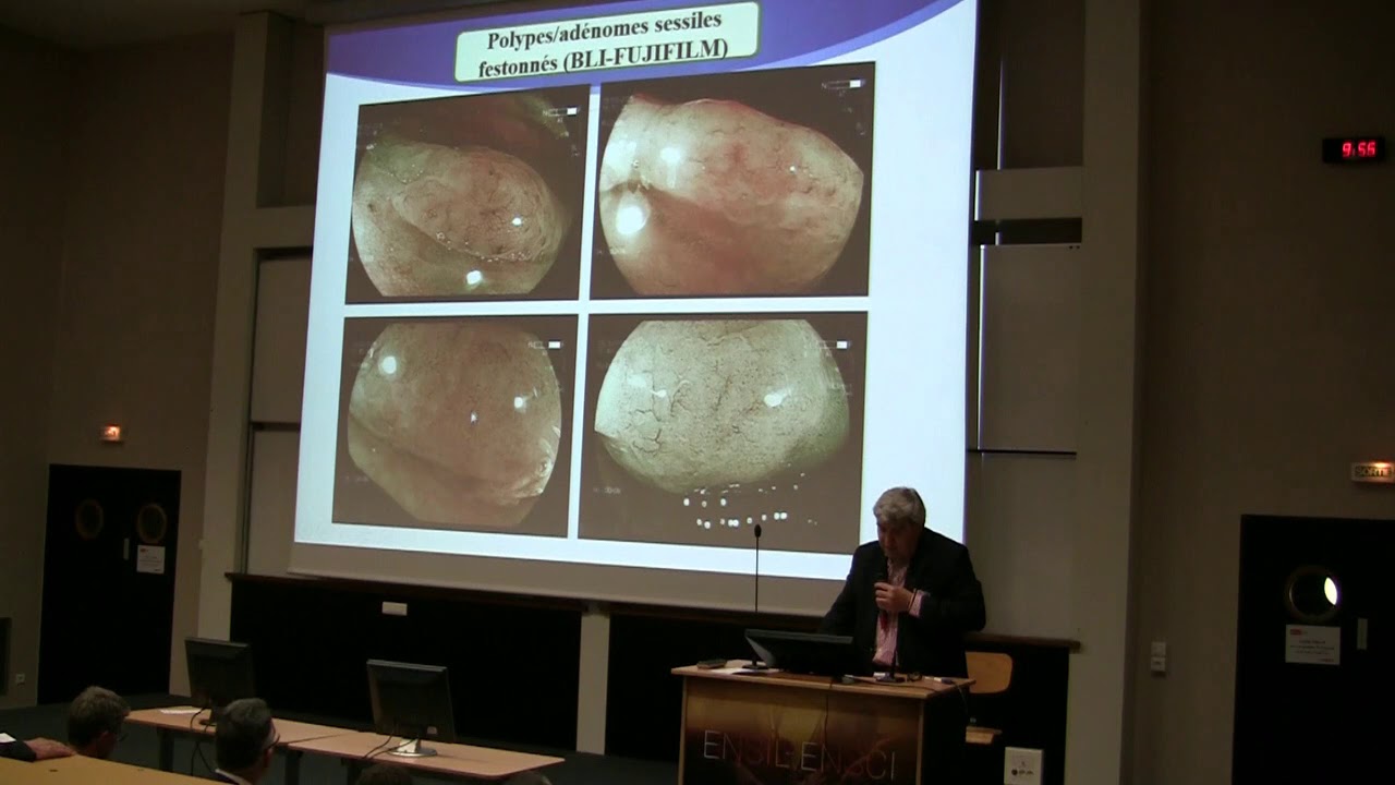 Caractérisation des polypes coliques - Pr. Stanislas CHAUSSADE (Paris ...