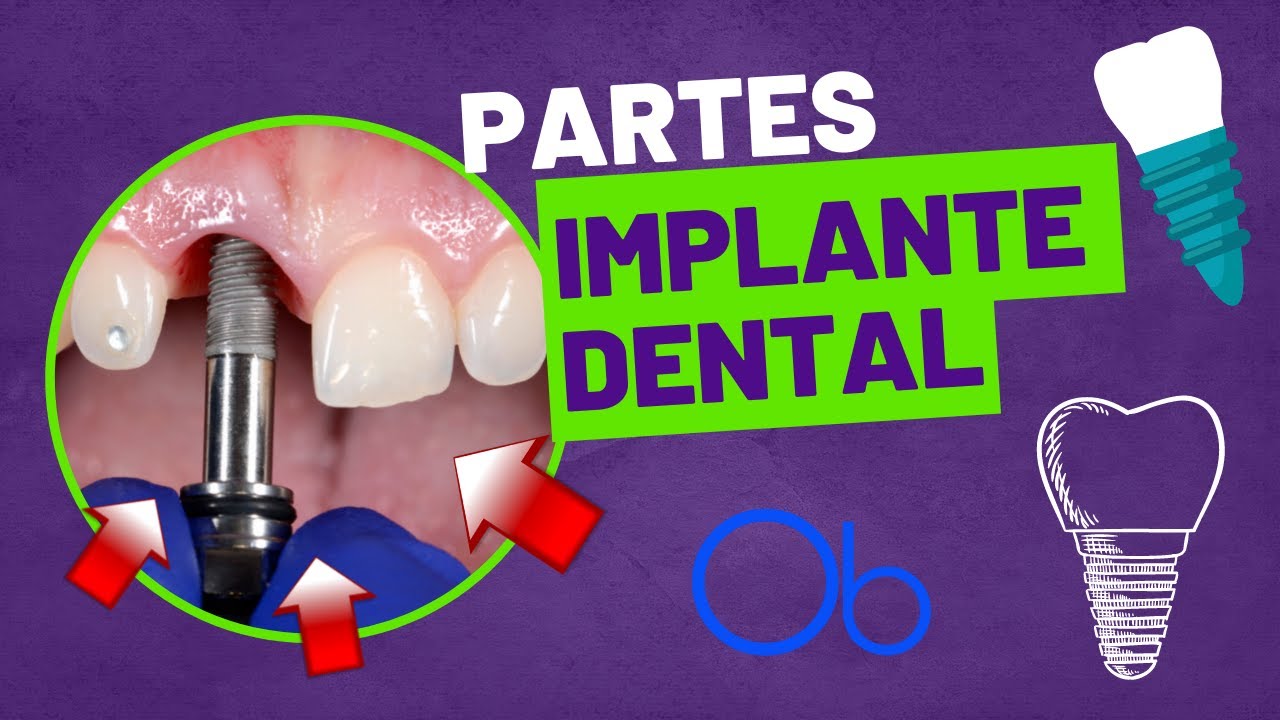 PARTES DEL IMPLANTE DENTAL - YouTube