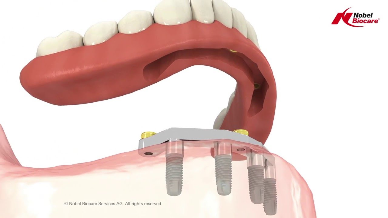 Removable implant supported denture - YouTube