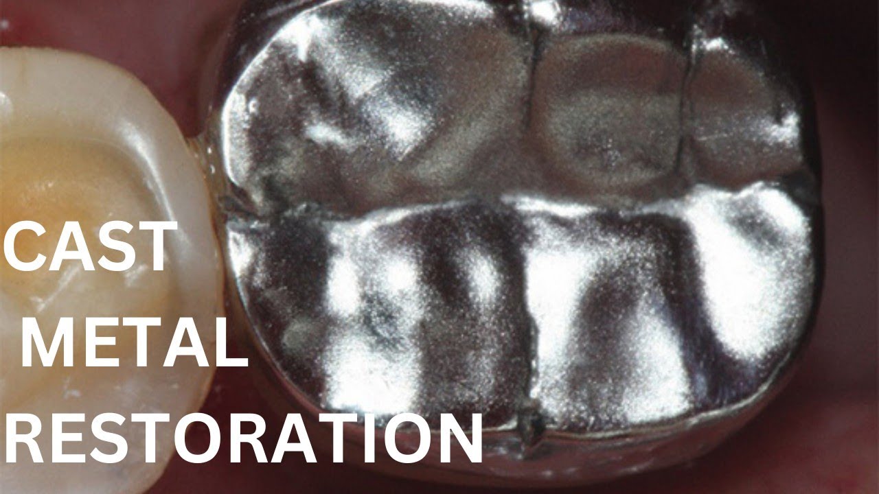 Cast Metal Restoration - YouTube