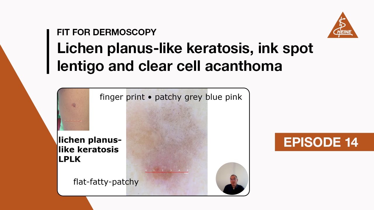 Fit for Dermoscopy Episode 14 - Lichen planus-like keratosis, ink spot ...