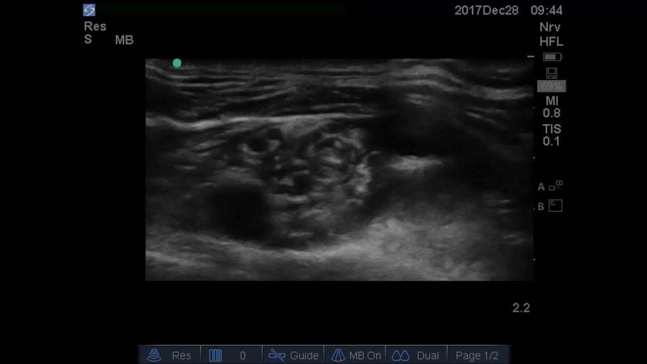 USG GUIDED INTERSCALENE BRACHEAL PLEXUS BLOCK WITH 15 ML LA DRUG SPREAD ...