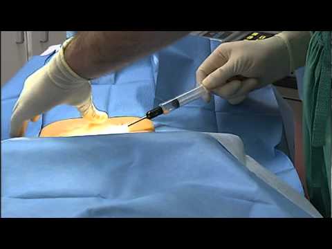 Lipo Transfer - YouTube