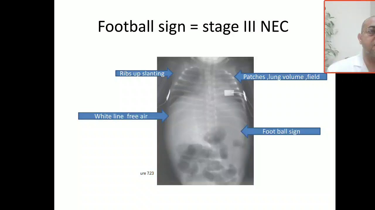 Case 102 Football sign Gut perforation related to dexamethasone DART ...