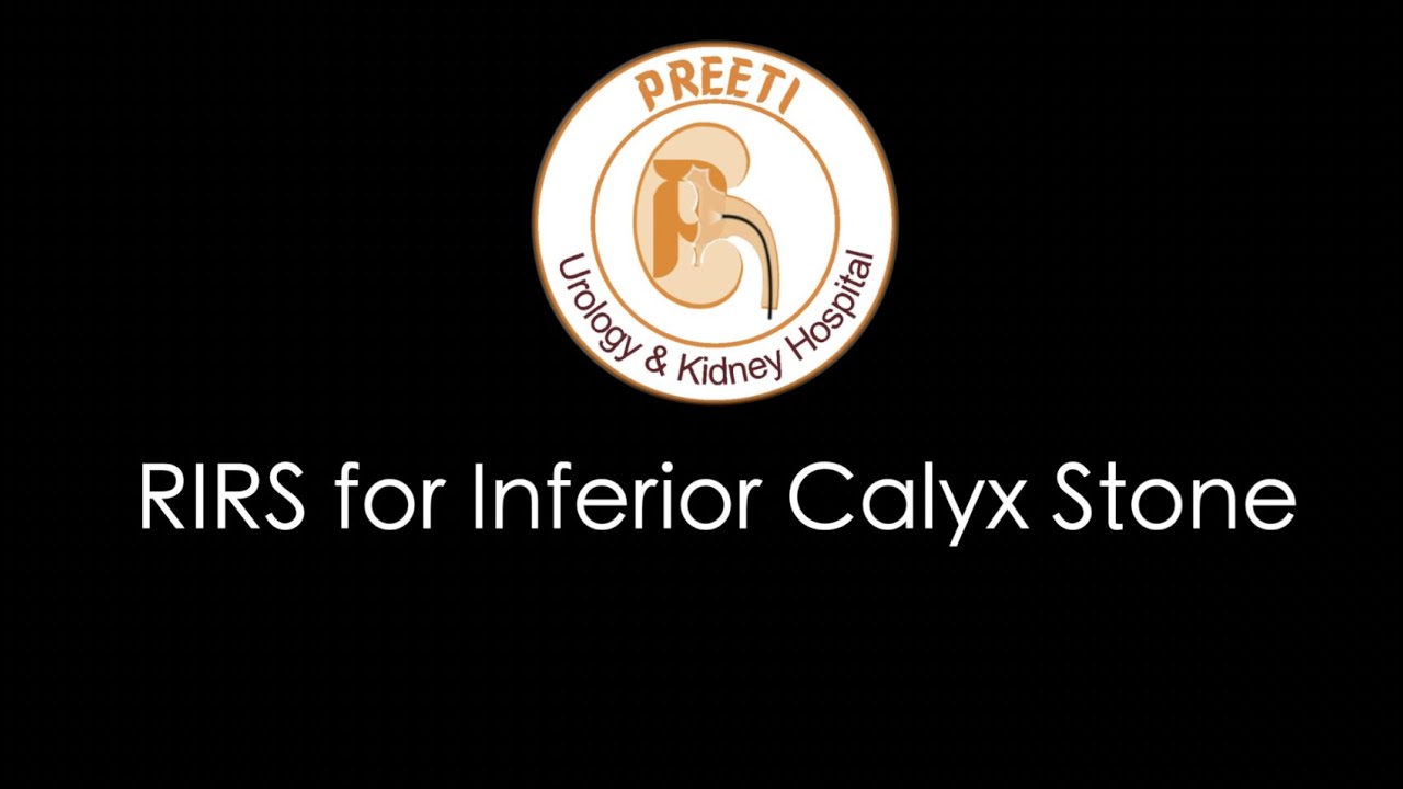 RIRS for inferior calyx stone | Preeti hospitals - YouTube