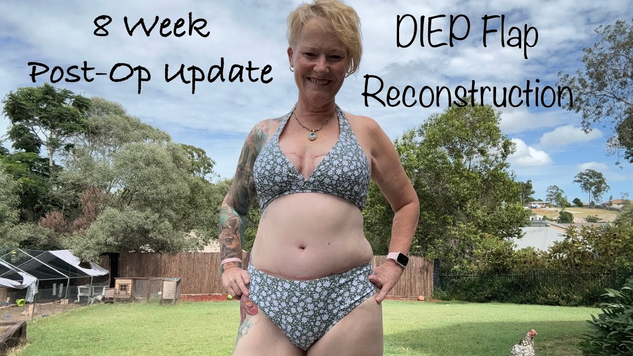 8 Week Post Op DIEP Flap Reconstruction Update - YouTube