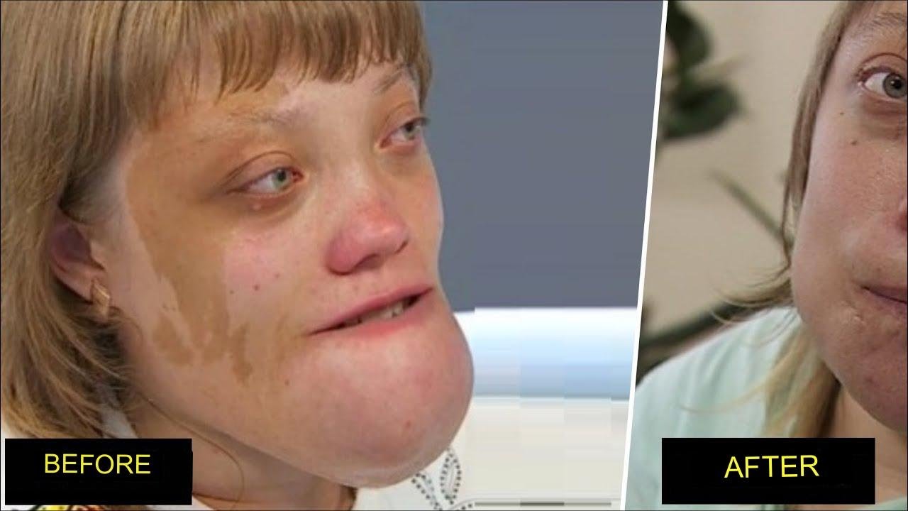 HIS/HER JAW KEPT ON GROWING and after a surgery, LOOK HOW IT IS NOW ...