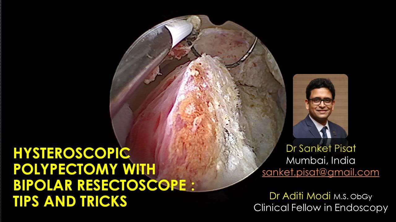 Hysteroscopic Polypectomy with Resectoscope | Tips n tricks (with ...