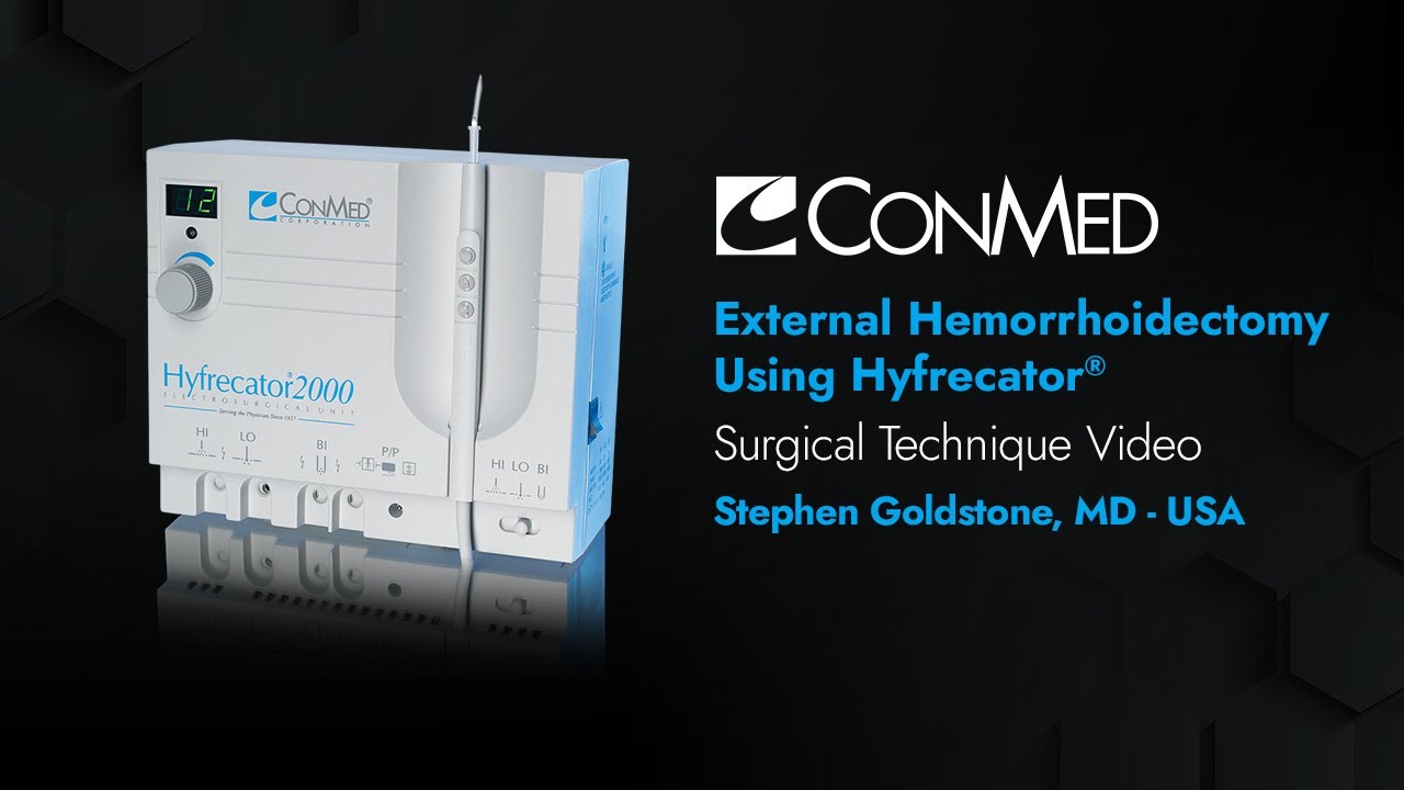 Dr. Stephen Goldstone - External Hemorrhoidectomy Using Hyfrecator ...