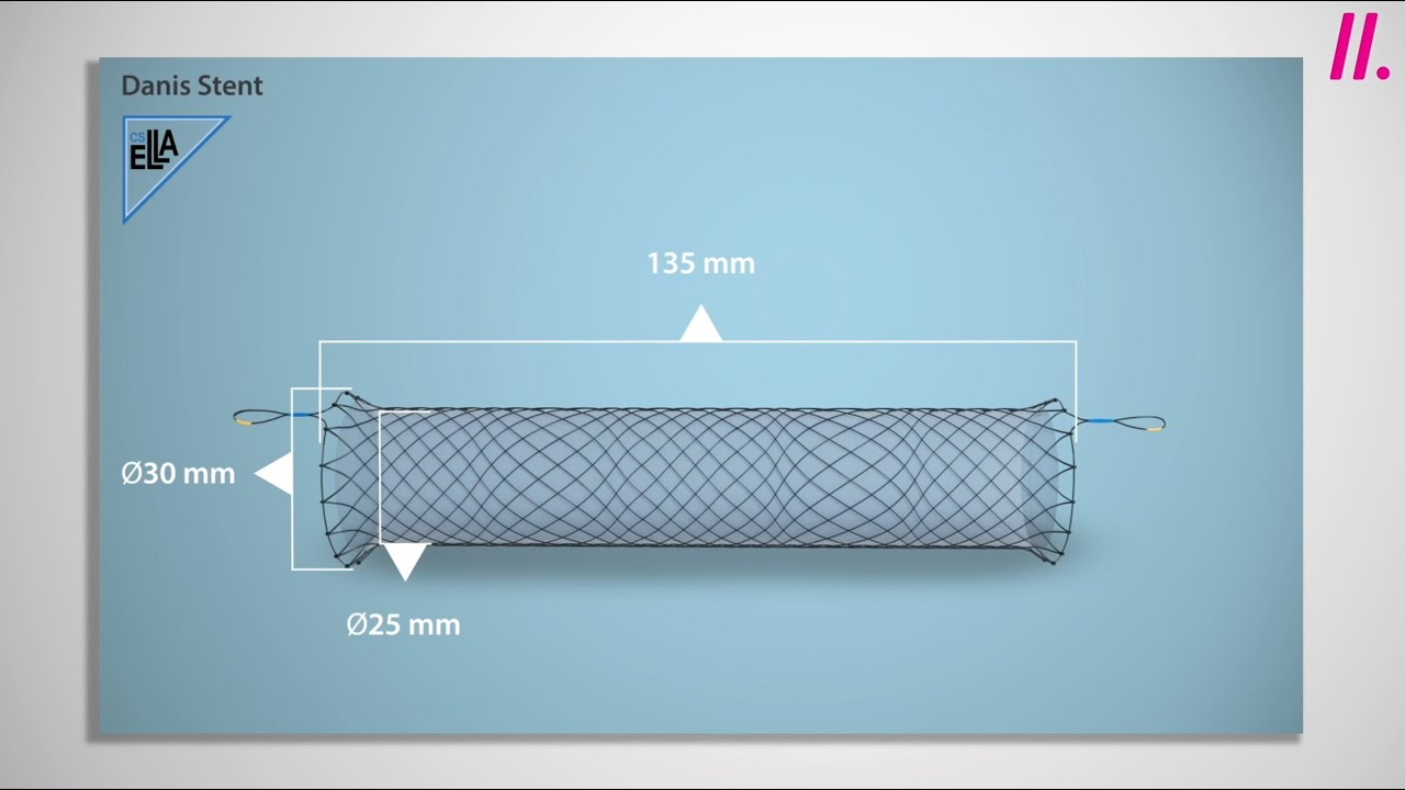 Danis Stent - Implant Technique - YouTube