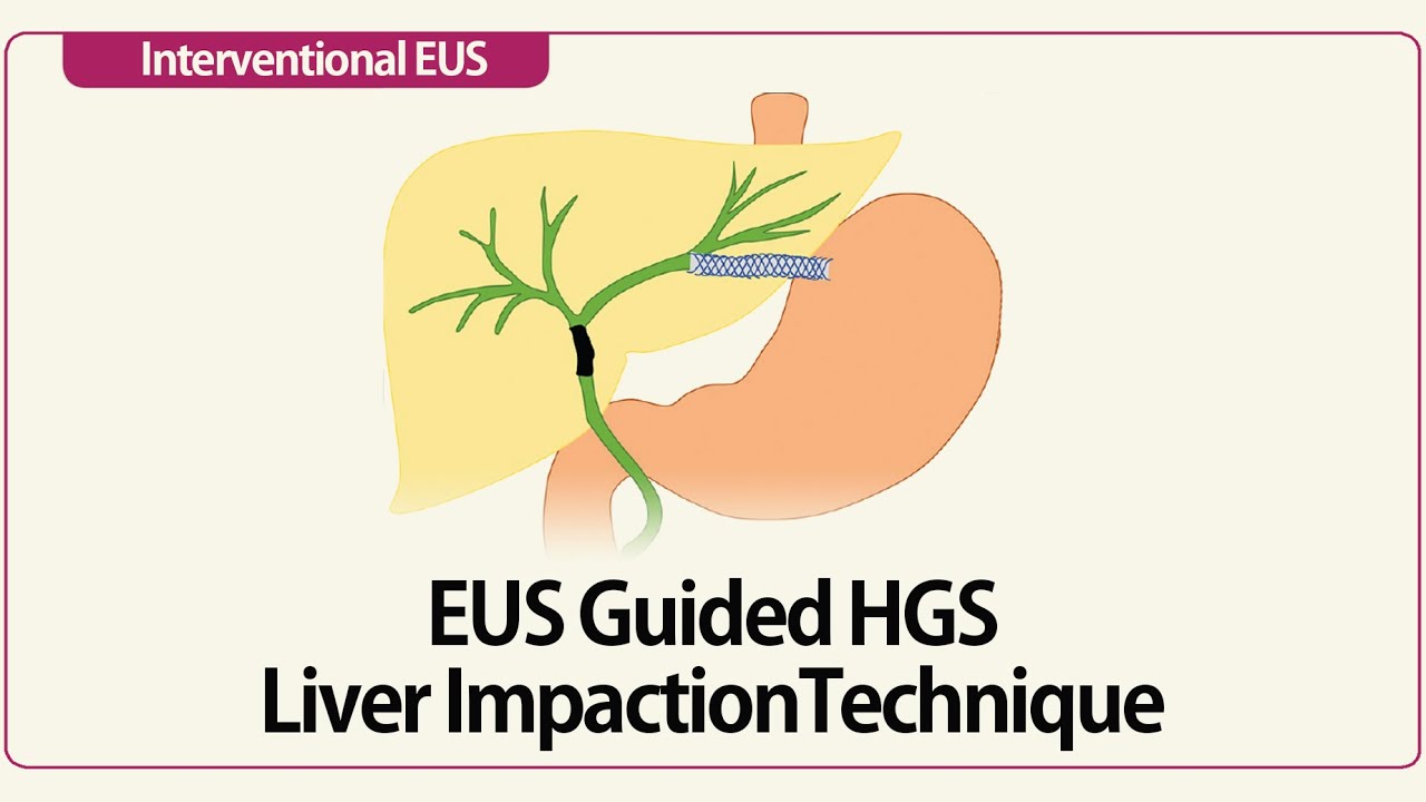 EUS Guided HGS - Liver Impaction Technique - YouTube