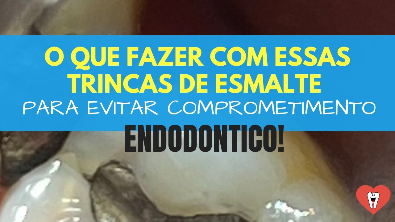 O QUE SE DEVE FAZER COM ESSA TRINCA DE ESMALTE PRA EVITAR UM TRATAMENTO ...