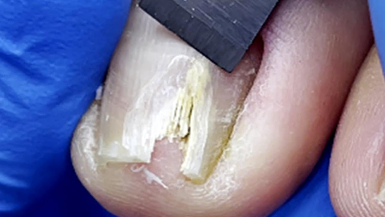 Pedicure Tutorial：Scrape off broken toenails【Pedicure Master Lin Jun ...