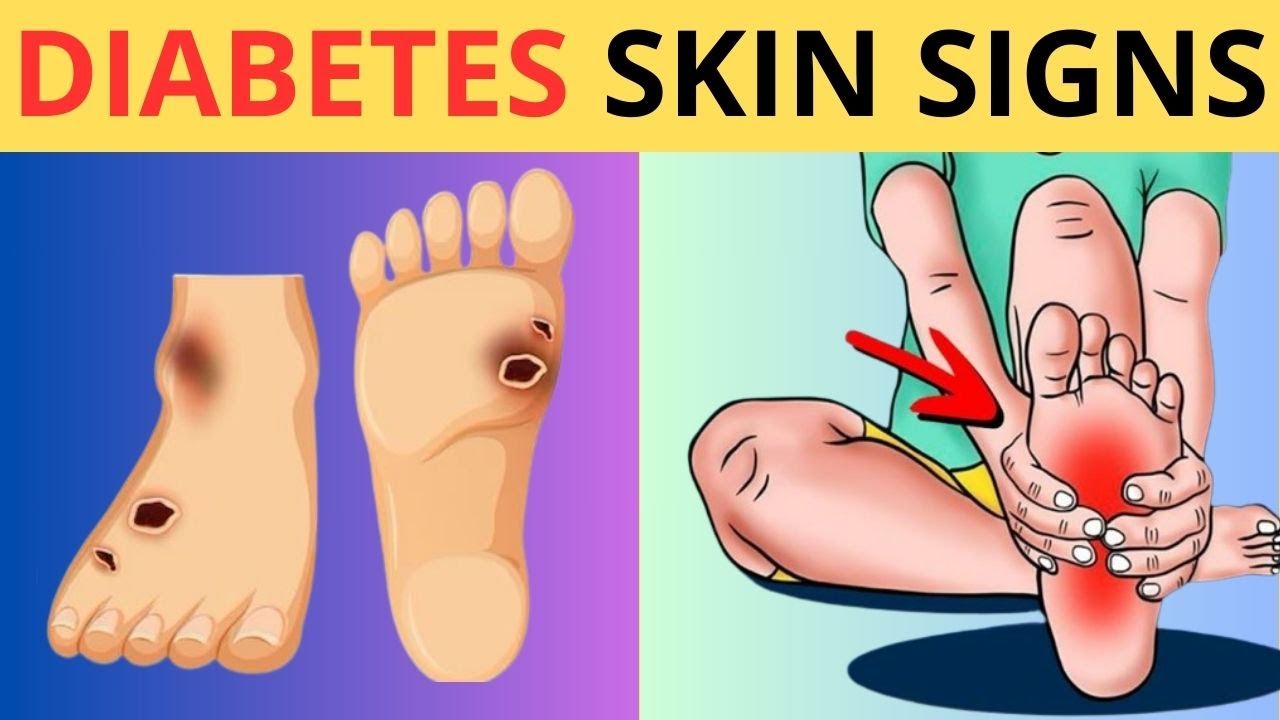 9 Diabetes Critical Skin Signs (You Must Not Ignore) - YouTube