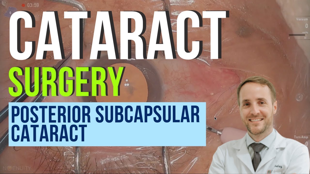 Rutine Cataract Surgery - Posterior subcapsular cataract - YouTube
