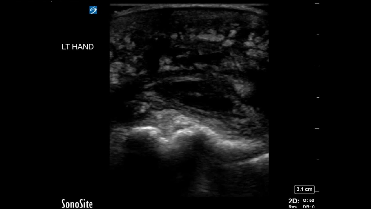Inguinal Abscess Ultrasound