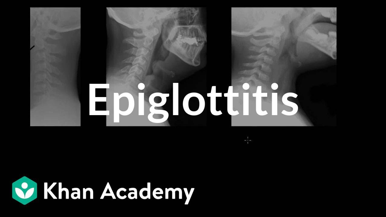 Epiglottitis X Ray Vs Normal