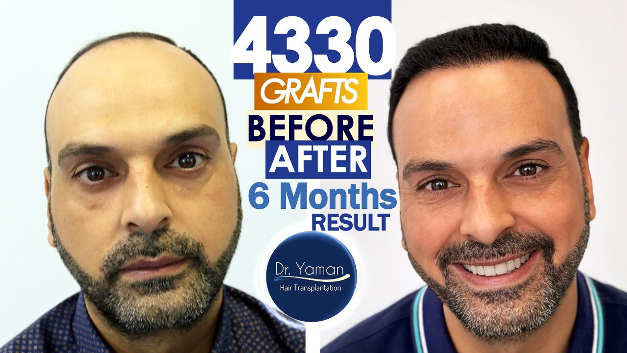 4330 Grafts Hair Transplant Before After Result | Dr Resul Yaman - YouTube