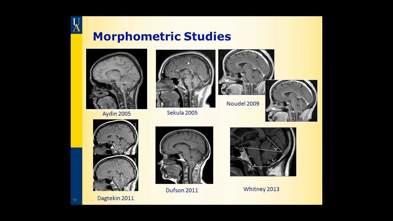 Morphometric-Based Classification for Chiari Malformation - YouTube