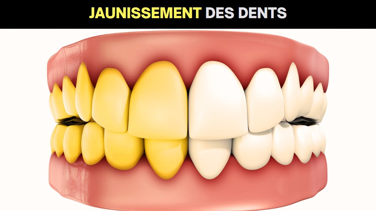 Qu'est-ce qui cause le jaunissement des dents OU la décoloration des ...