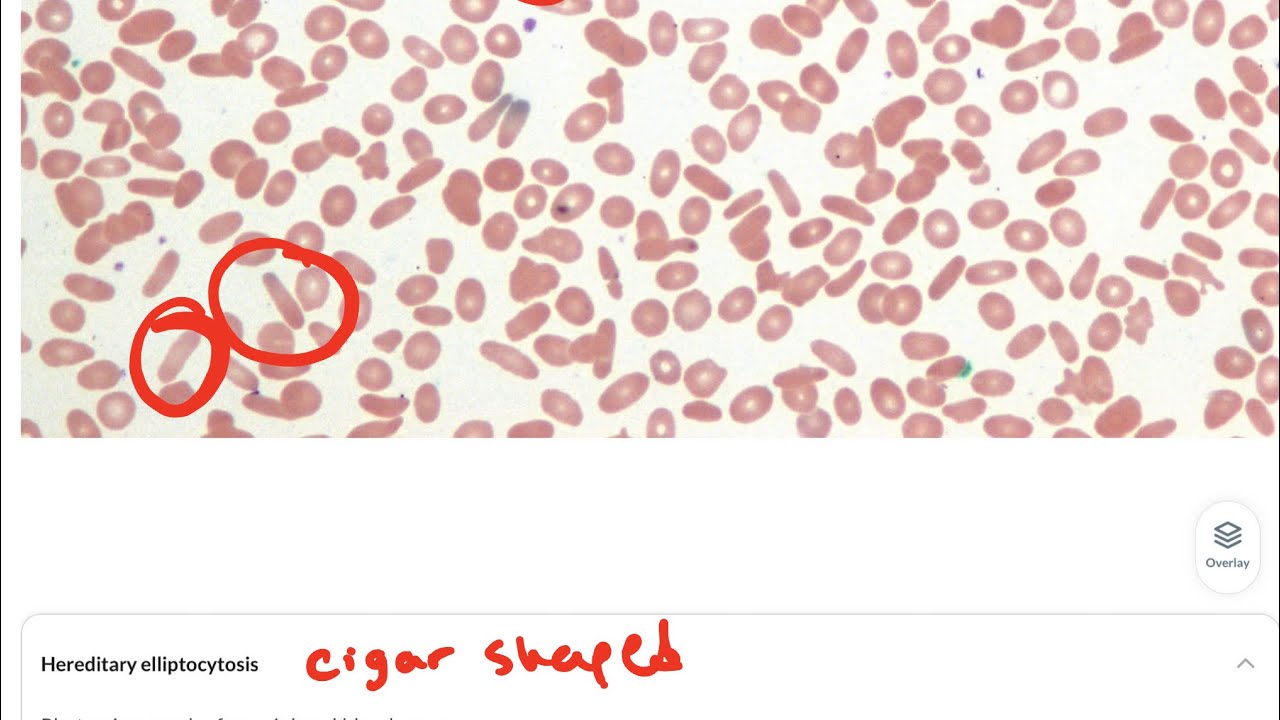 Different RBC Morphologies - YouTube