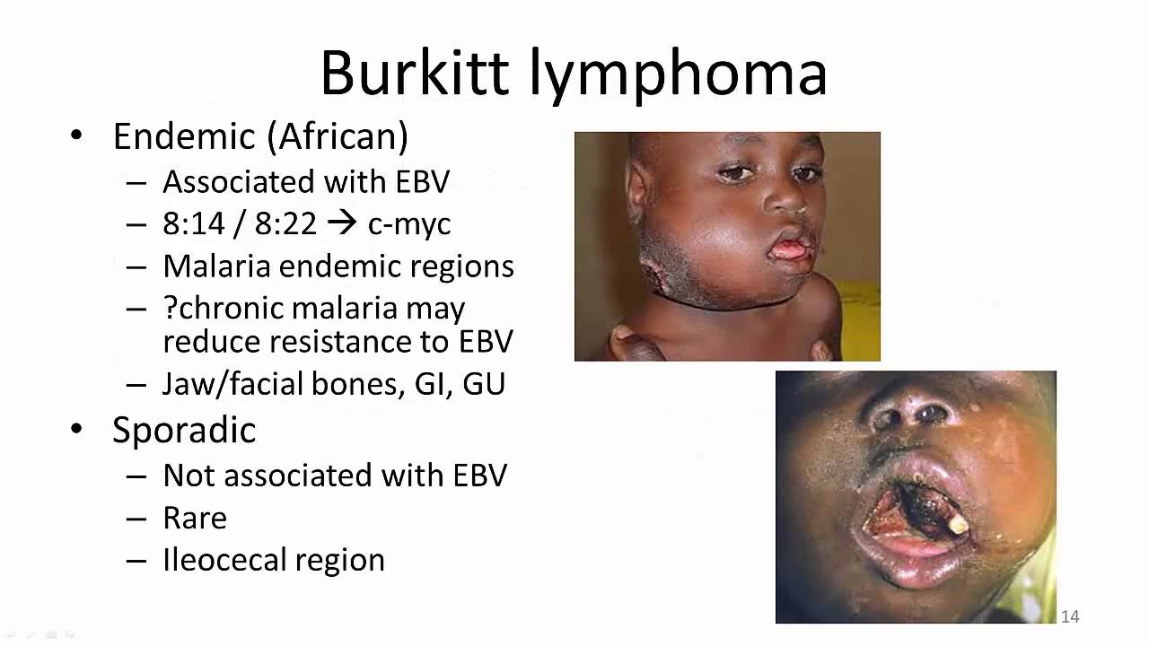 3. Chronic EBV - YouTube