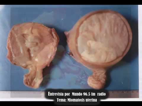 MIOMATOSIS UTERINA DE 6 CM. - YouTube