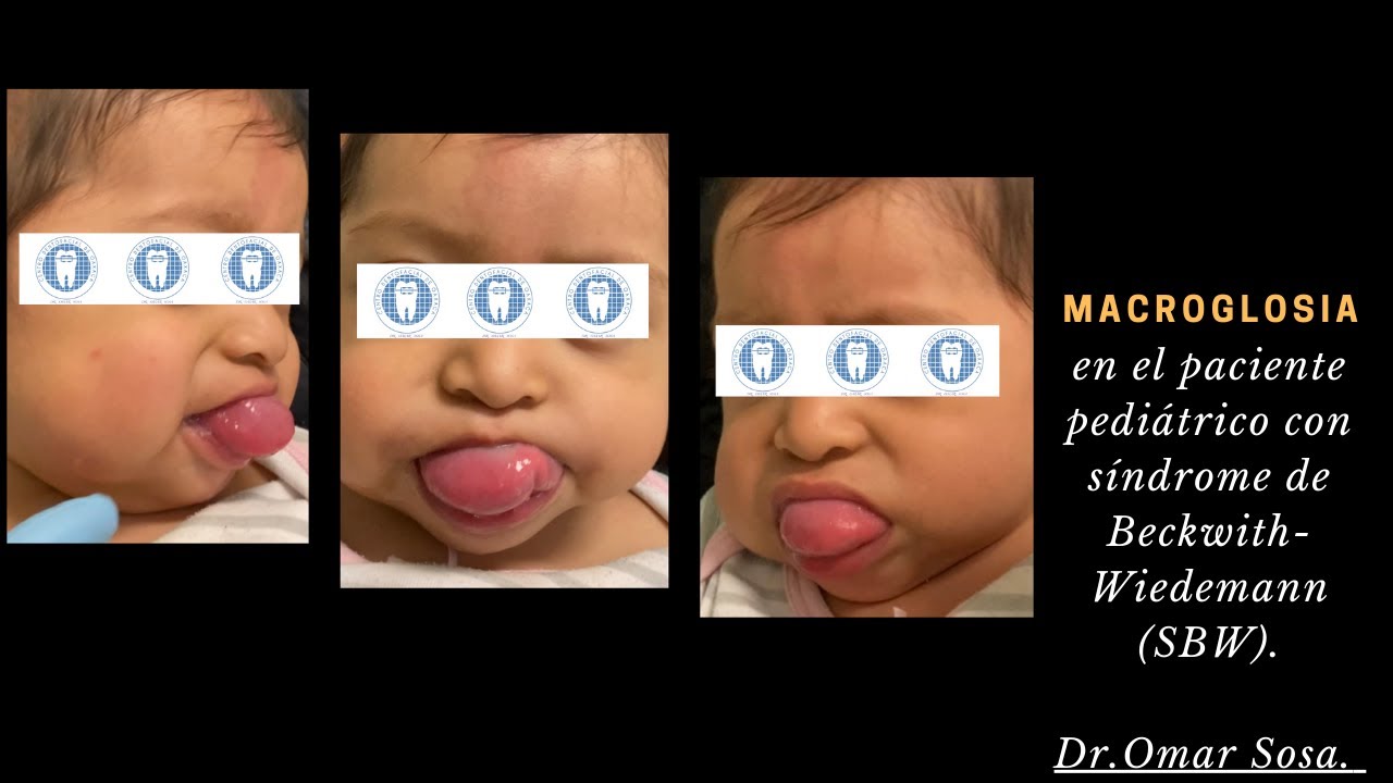 Espectro Da Síndrome De Beckwith-wiedemann. - RETOEDU