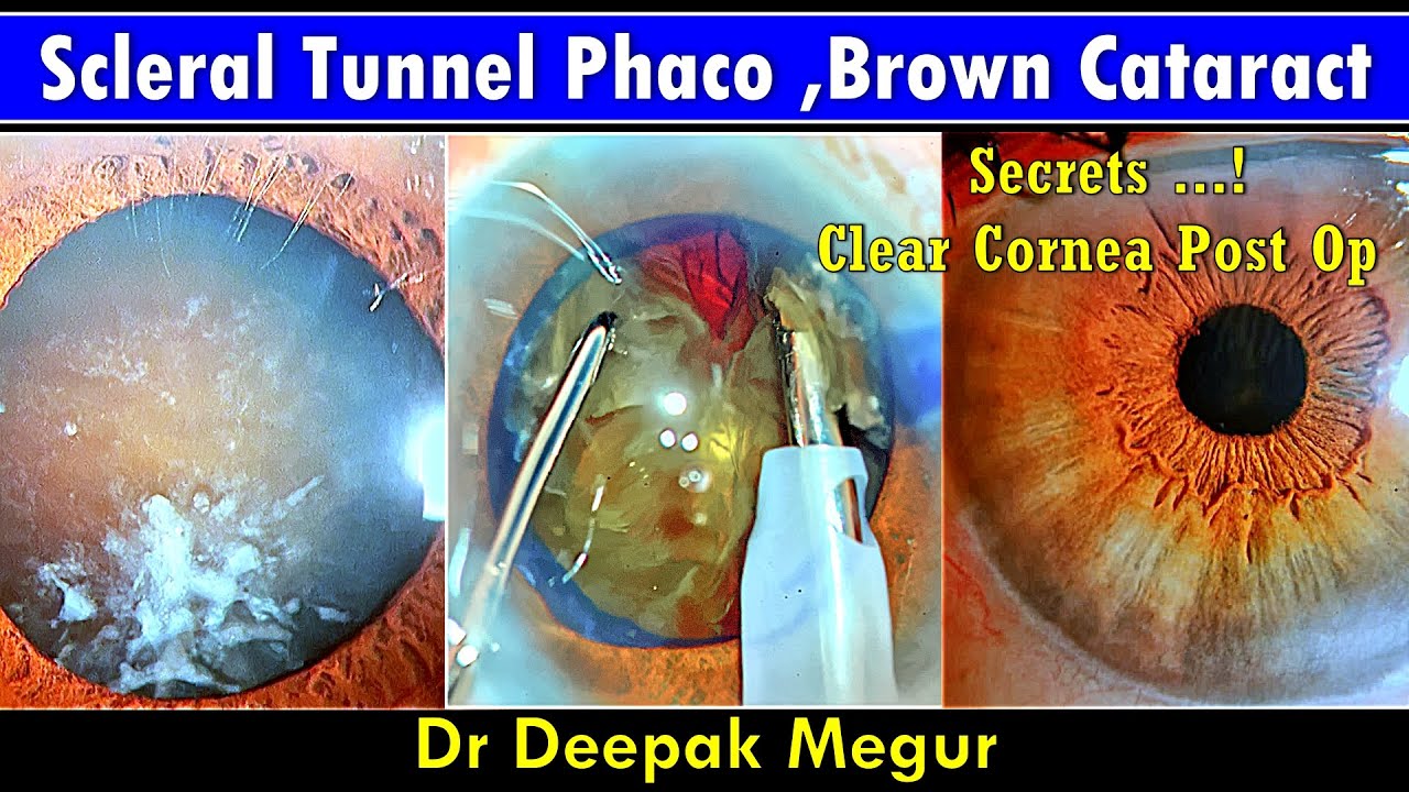 Scleral Tunnel Phaco for Very Hard Cataract. Clear Cornea Secrets. Dr ...