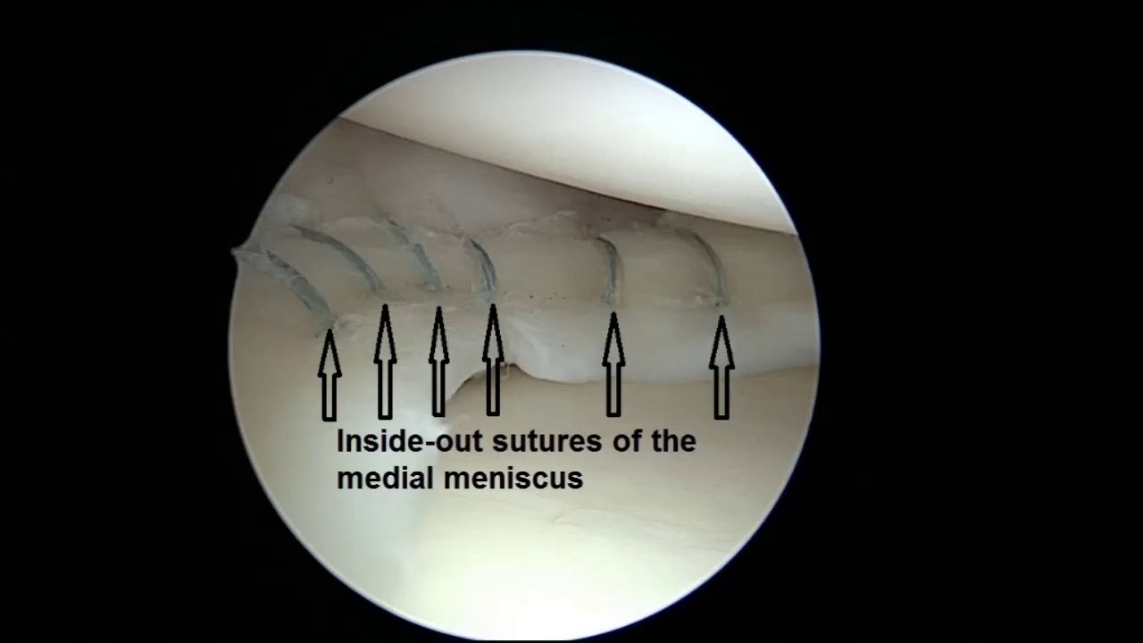Inside-out Repair of Extensive Meniscal Tears Using Posteromedial and ...