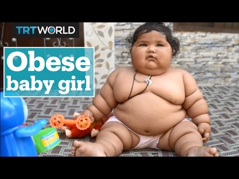 Obese baby leaves doctors confused