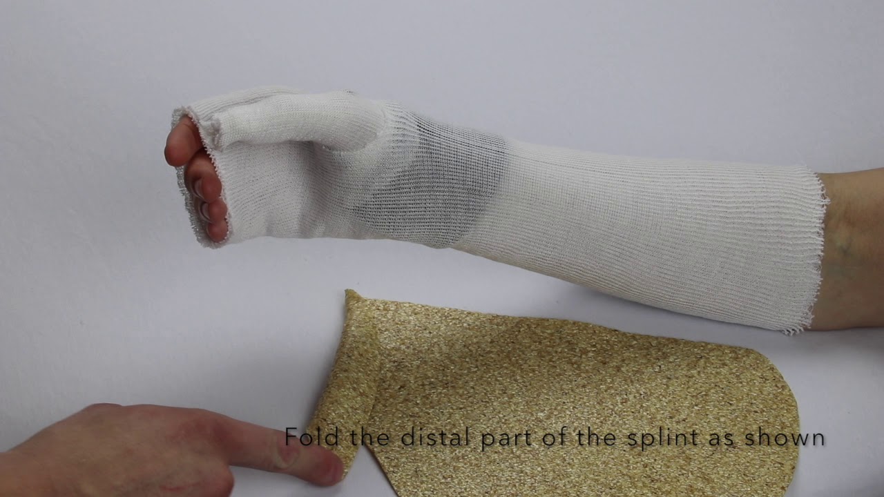 Woodcast 4in1 scaphoid - YouTube